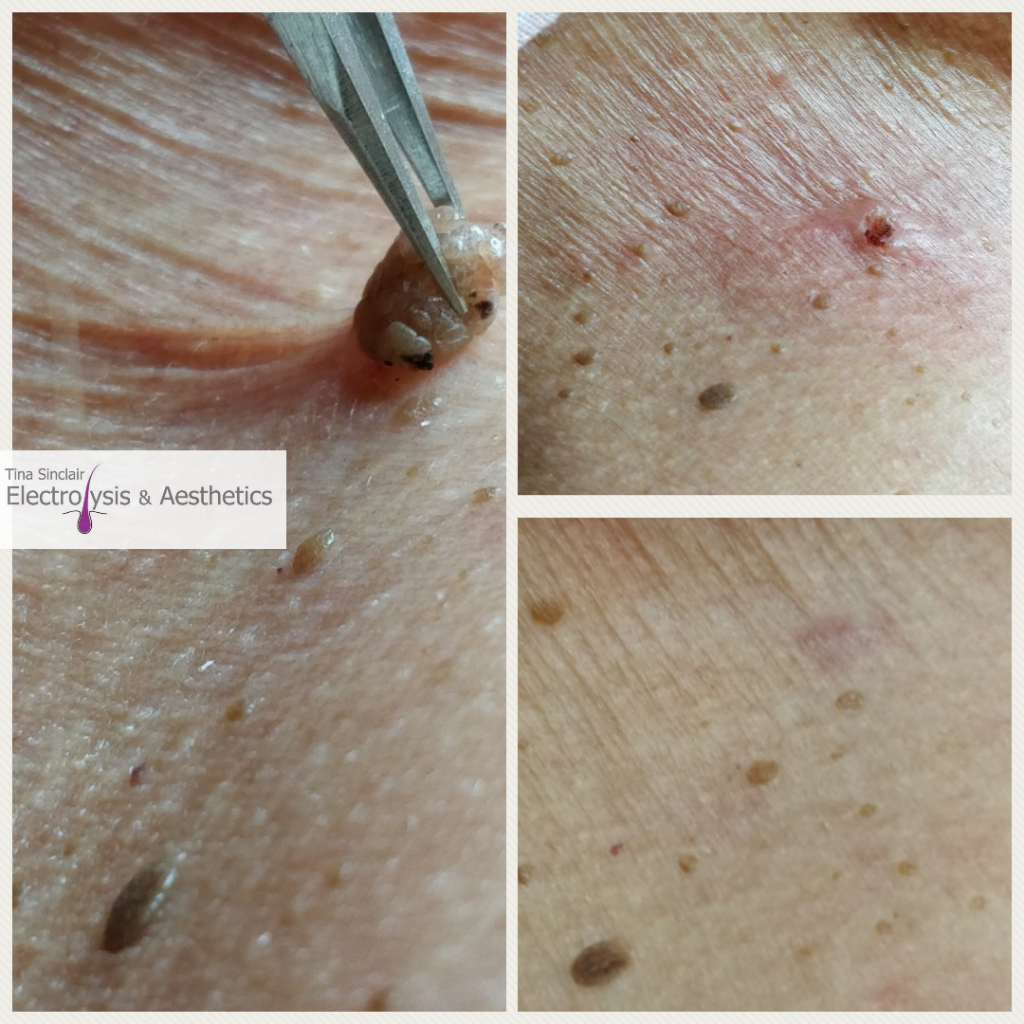Skin Tag Removal | Wart Treatment | Keratosis | Milia | Edinburgh Scotland