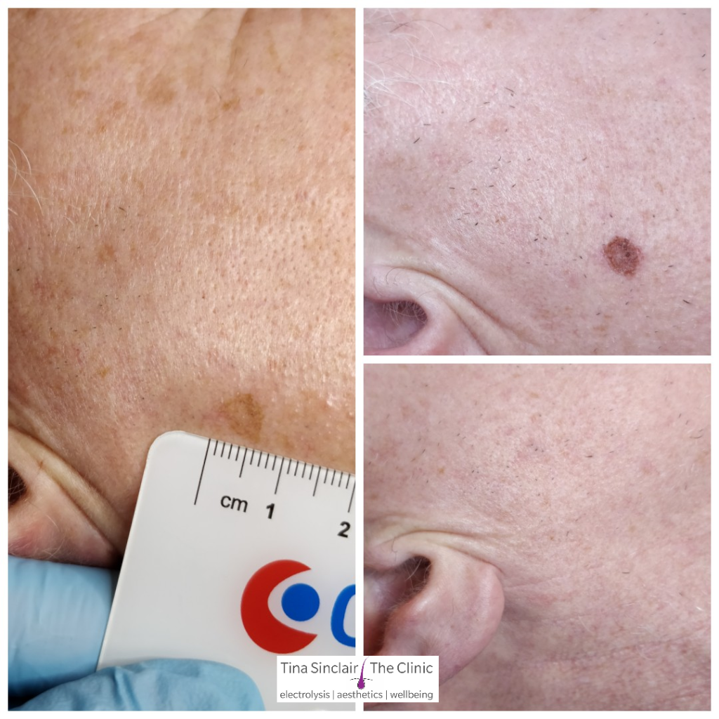 Pigmentation Patches (UV induced)