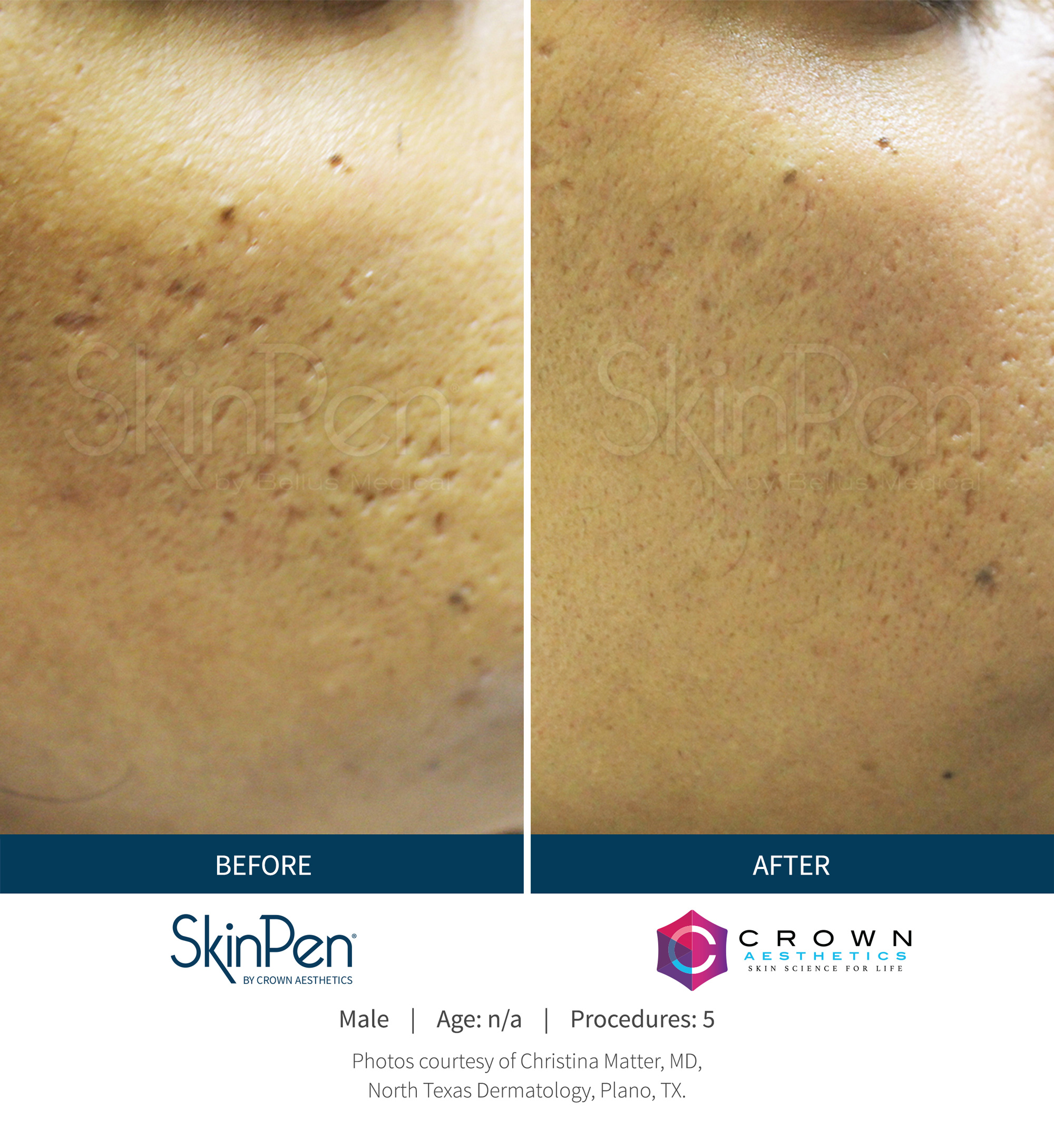 SkinPen_Acne_Texas_Female_NA_Before-and-After-Picture_1